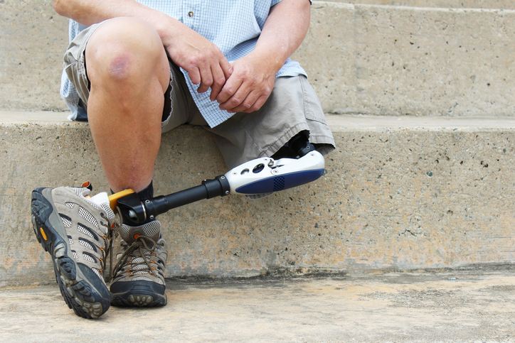 Recovering for Lost Limbs or Amputations Resulting from Accidents - Injury